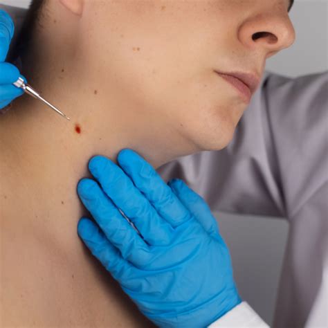 Exéresis De Nevus Dra Denisse Granda Dermatología Y Estética
