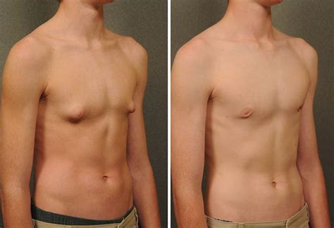 Male Breast Reduction Advanced Gynaecomastia Treatment