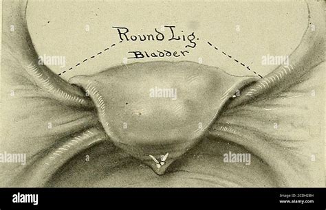Gynecology W T S 3 Q Q S Catccx Stumv Fig 381 —supravaginal