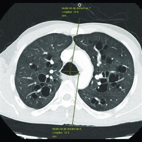 Bronchoscopy Showing The Trachea With A Marked Increase In Diameter