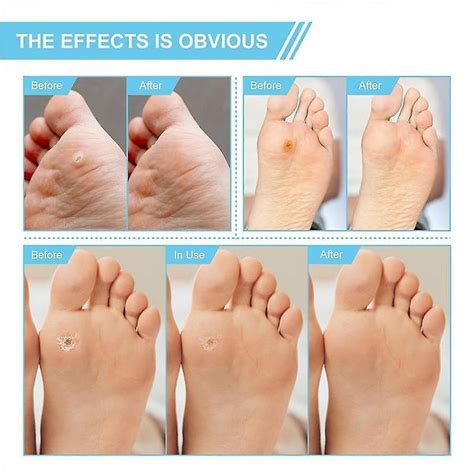 Hot Foot Corn Killer Plaster Patch Plantar Calluses Remover Pad Feet Toe Protector Skincare