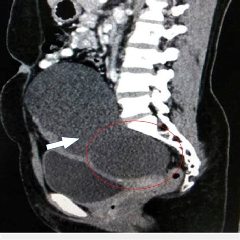 Contrast Enhanced Ct Scan Of Pelvis Showing Cyst Arising From Douglas
