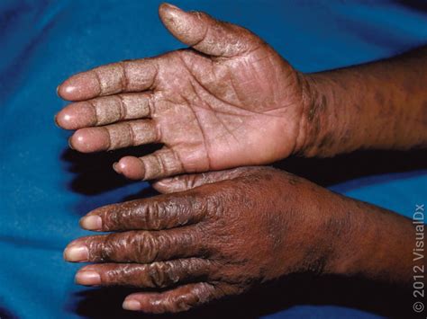 Allergic Reaction On Hands
