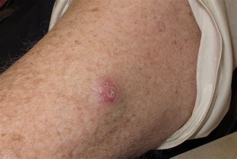 What Is Skin Cancer Pictures