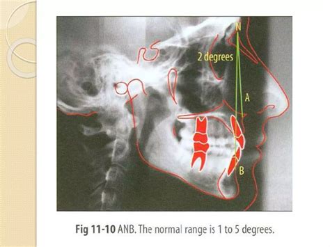 Ricketts Analysis Analysis Facial Esthetics Dental Academy