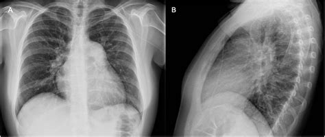Abordaje De La Hipertensión Arterial Pulmonar Para El Clínico