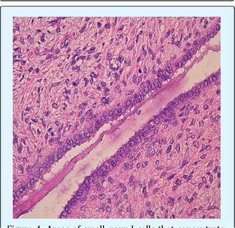 Figure 4 From Uterine Adenosarcoma With Low Grade Overgrowth And Smooth Muscle Differentiation