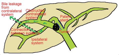 Causes And Treatment Of Bile Leaks At The Puncture Site After