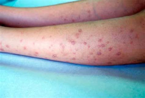 Gonococcal Infection Symptoms