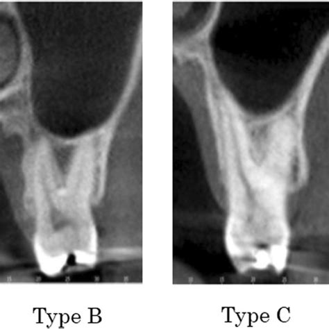 Archer Third Molar Classification 8 1 Mesioangular 2 Download Scientific Diagram