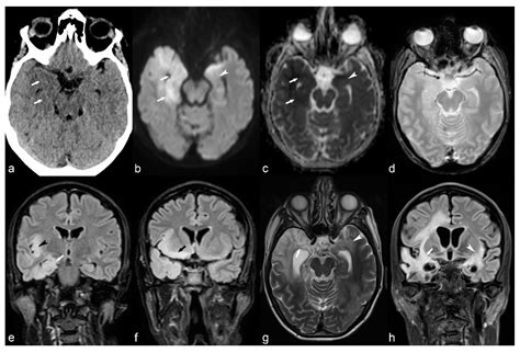 Morphological And Advanced Imaging Of Epilepsy Beyond The Basics