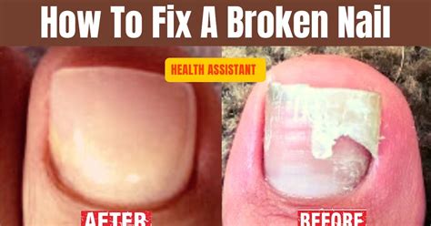 3 Ways To Treat A Torn Toenail How To Fix A Torn Toenail How To Fix