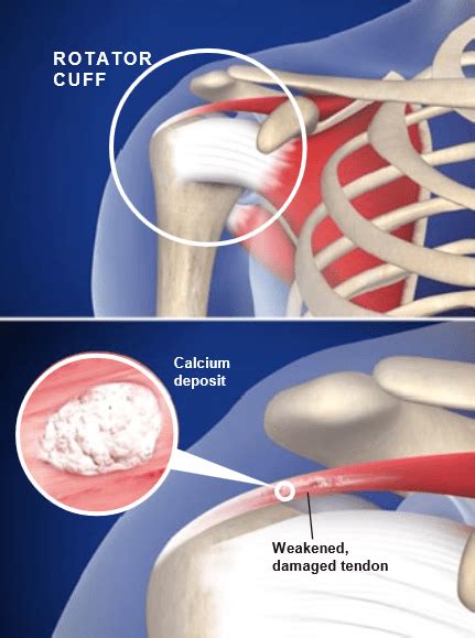 Calcific Tendinitis Of The Shoulder Central Coast Orthopedic Medical