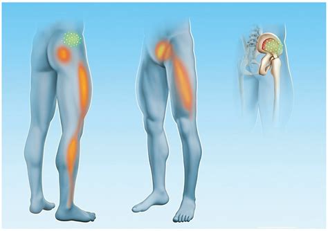 The Use And Benefits Of Focused Shockwaves For The Diagnosis Of