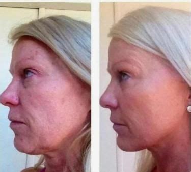 Before And After Results In 30 Days Anti Aging Skin Products Skin