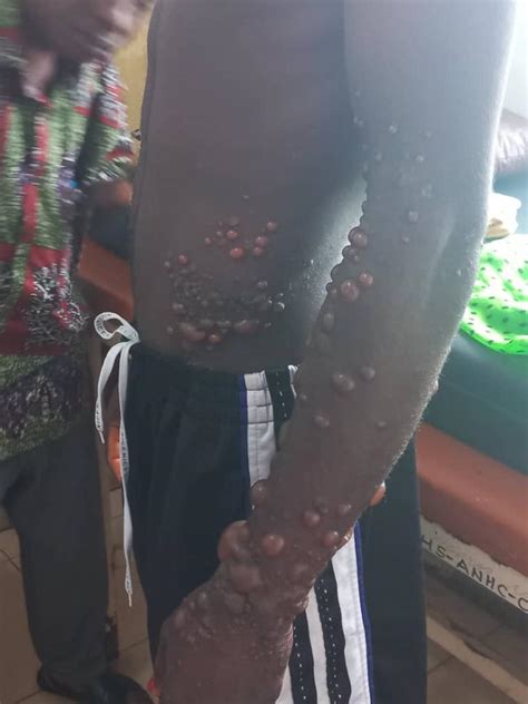 No Confirmed Case Of Monkeypox In Western Region Ghs Radio Gold 905 Fm