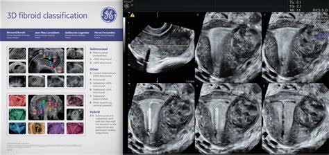 Uterine Fibroid Management And Treatment Options Empowered Womens Health