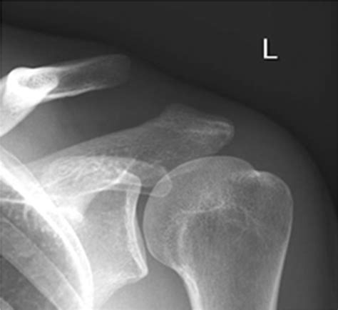 Luxación Acromioclavicular Lac Aguda Resultados Con Técnica De Doble
