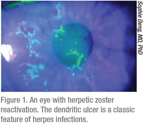 Dendritic Ulcer