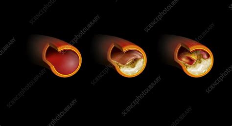 Development Of An Atheroma Artwork Stock Image C0095859 Science