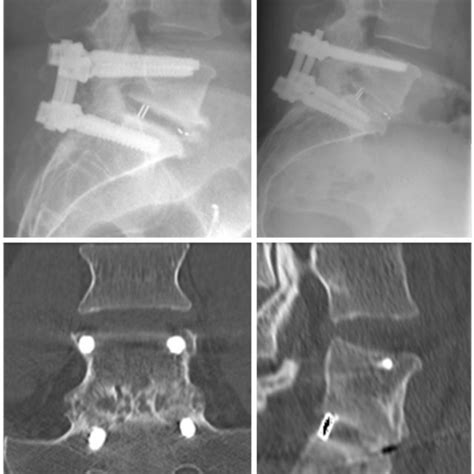 42 Year Old Female Plif With Uncoated Cages At L45 A Standing X Ray