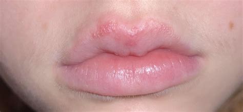 Red Bumpy Raw Scaly Rash On And Around Lips Rdermatology Red Bumpy Raw Scaly Rash On And Around Lips Rdermatology