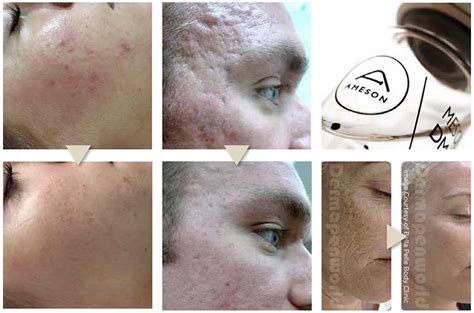 Dermapen™ Mesotherapy Ema Skin Aesthetics Preston