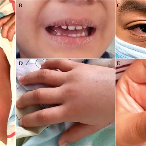 A Rash Maculopapular Difuso Eritema Y Edema De Manos Labios