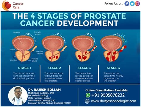 Prostate Cancer Stages