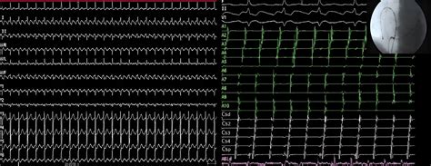 Cavotricuspid Isthmus Dependent Atrial Flutter Beyond Simple Linear Ablation