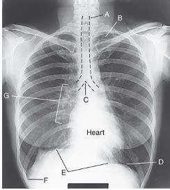 Labelling Chest X Rayslandmarks Flashcards Quizlet