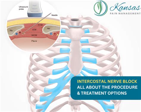 Intercostal Nerve Block Procedure And Treatment Options