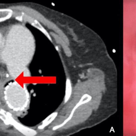 A Ct Image Demonstrating Air Adjacent To The Endograft Within The