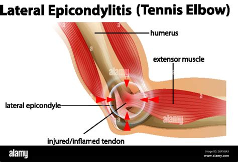 Lateral Epicondyle Injection