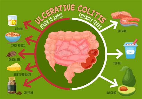 Ulcerative Colitis Gut Disease Dieting Diet Advice For Treatment Of
