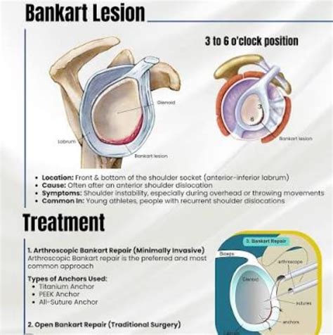 Bankart Lesion Vs Slap Lesion Are Both Shoulder Labral Injuries But