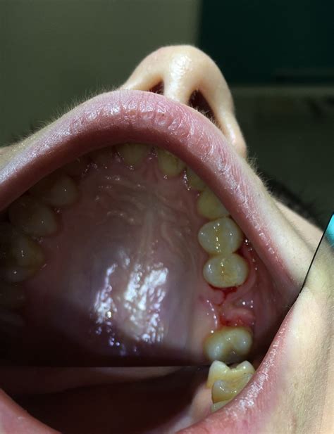 Sinusite Odontogena Dott Pier Francesco Amoroso