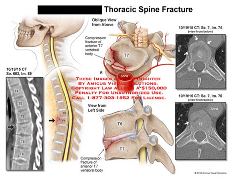 Thoracic Spine Fracture