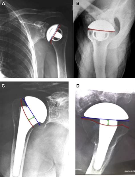 Proximal Humeral Osteolysis And Glenoid Radiolucent Lines In An