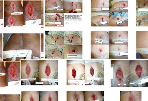 Complex Surgical Wounds And The Platelet Rich Plasma Option Case