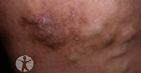 Varicose Dermatitis Image