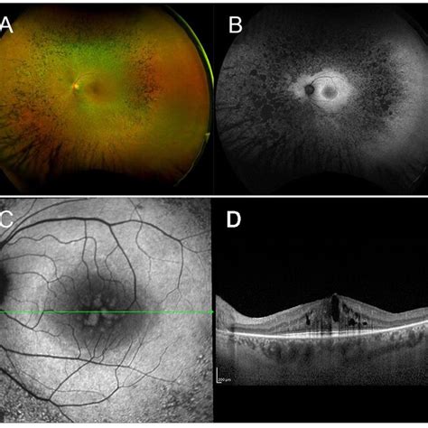 Multimodal Imaging In Stargardt Disease A Ultra Wide Field Download Scientific Diagram