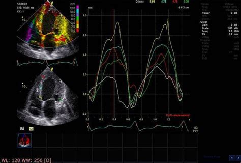 Strain Echo Heart Health Clinic