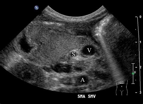 Ultrasound Imaging As The First Line Of Investigation To Diagnose
