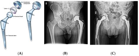 Updates On Biomaterials Used In Total Hip Arthroplasty Tha
