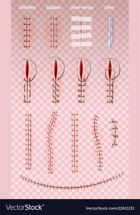 Surgical Suture Stitches Set Royalty Free Vector Image