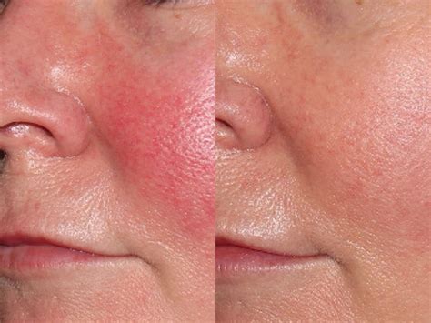 Mild Rosacea