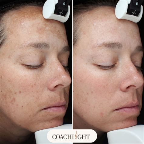Moxi Laser Treatment Des Moines And Ankeny Coachlight Clinic