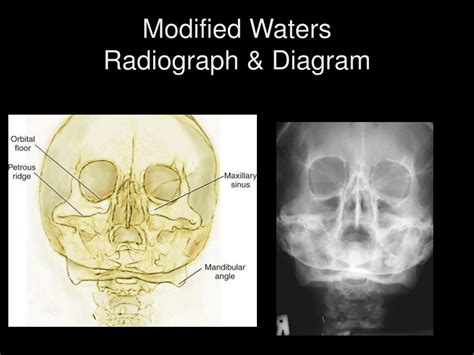 Ppt Radiography Of The Orbits Powerpoint Presentation Free Download