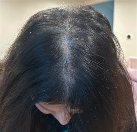 Pixie Human Hair And Handmade Topper Seully